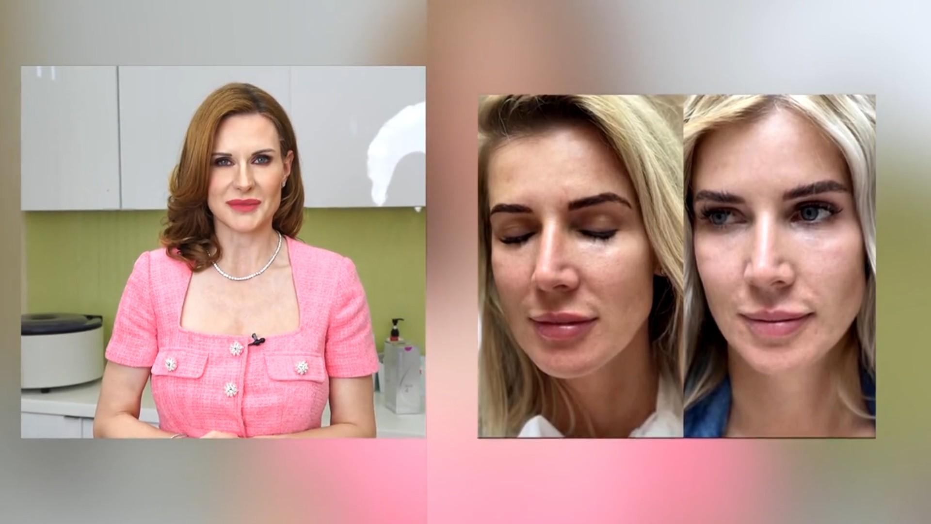 Dr. Phillips-Csernus Krisztina hialuronsavas arctöltése csodát művel